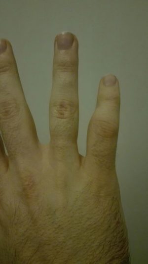 Kapselriss am Finger | Handballtraining TV